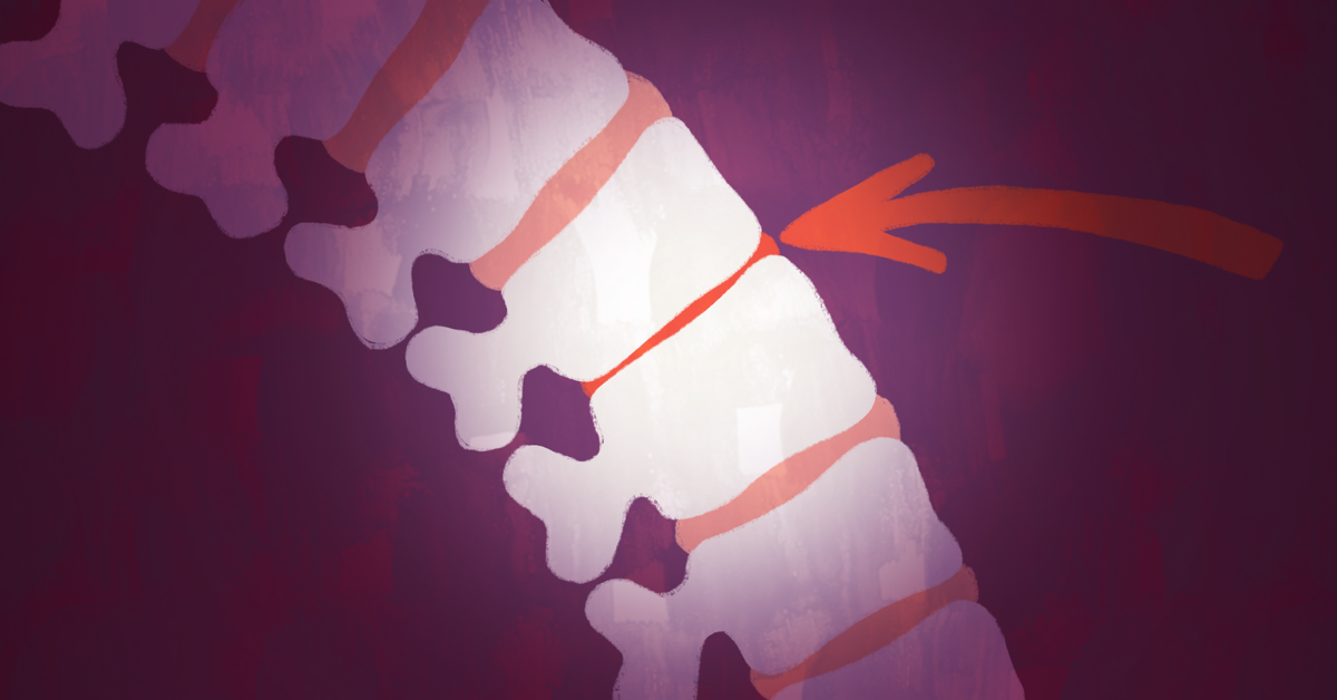 Back Problems Interfere with Life and Blood Cancer Treatments